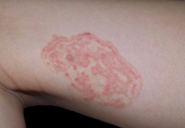 7 Alarming Signs of Type 2 Diabetes That Show Up on Your Skin - Healthy ...